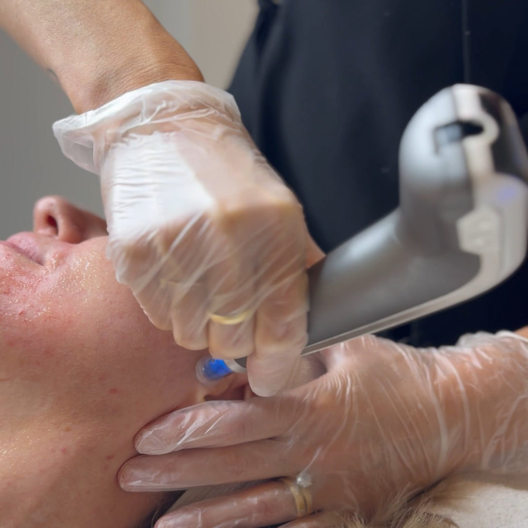 Skin Needling Brisbane | Microneedling at Amavi Beauty Lounge – Amavibeauty